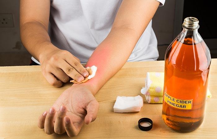 15 Best Home Remedies To Get Rid Of Ringworm's + Prevent Tips