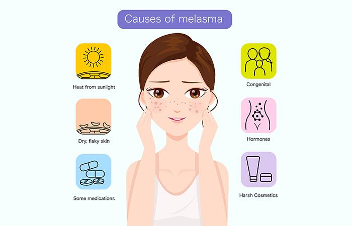 Melasma Vs. Hyperpigmentation: The Key Differences Between Them