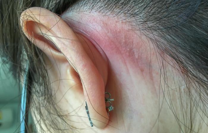 Cartilage Piercing Bump: Causes, Treatment, And Prevention