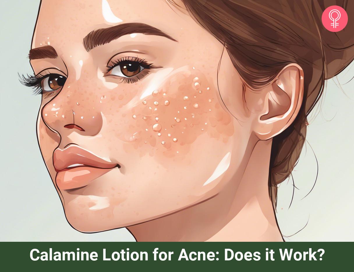 Calamine Lotion for Acne: Does it Work?
