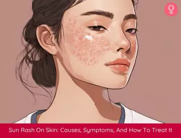Sun Rash On Skin: Causes, Symptoms, And How To Treat It